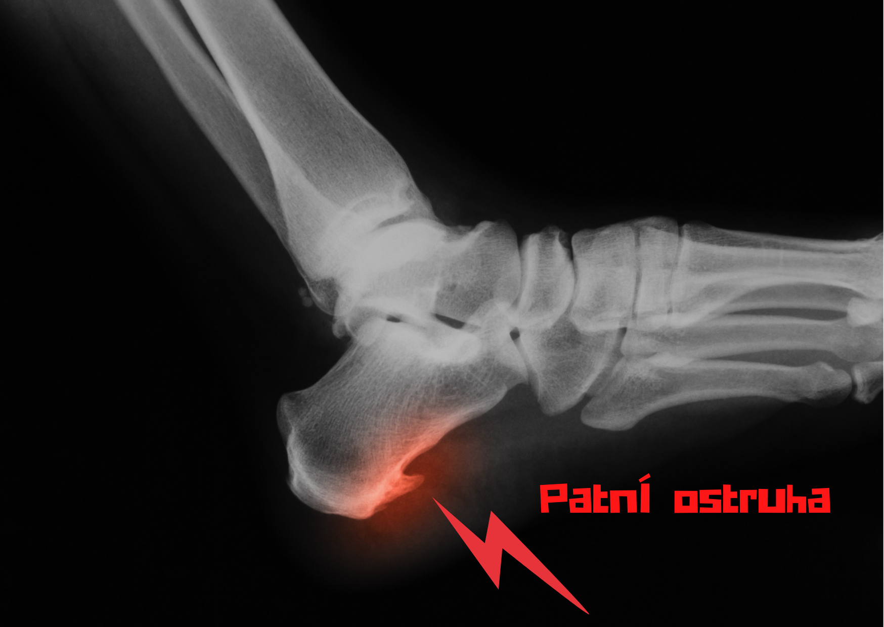 Bolest na každém kroku? Možná máte patní ostruhu! Co se s ní dá dělat ...